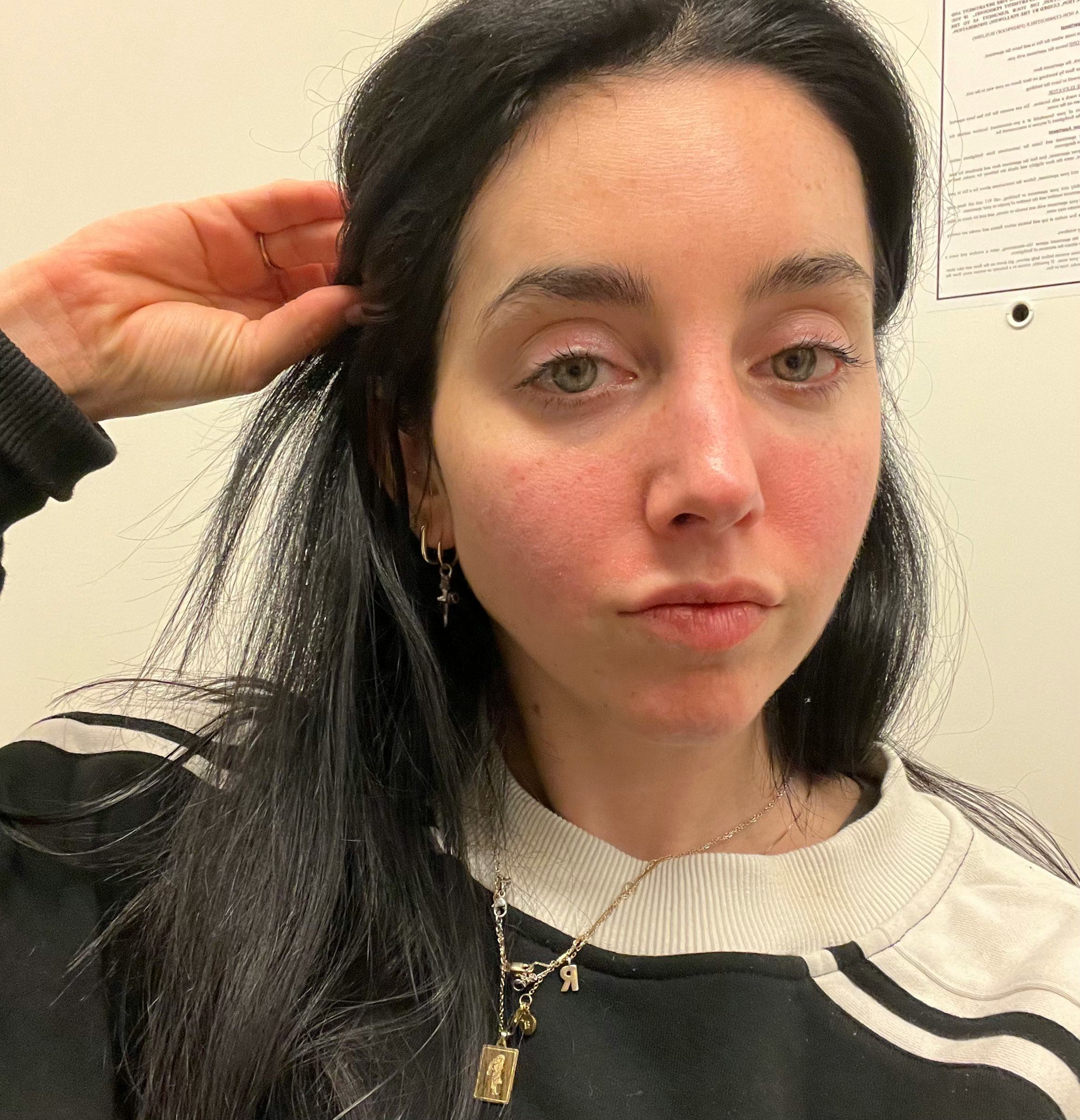 A Sofwave Review: The Benefits & Results Of The Buzzy Skin Treatment