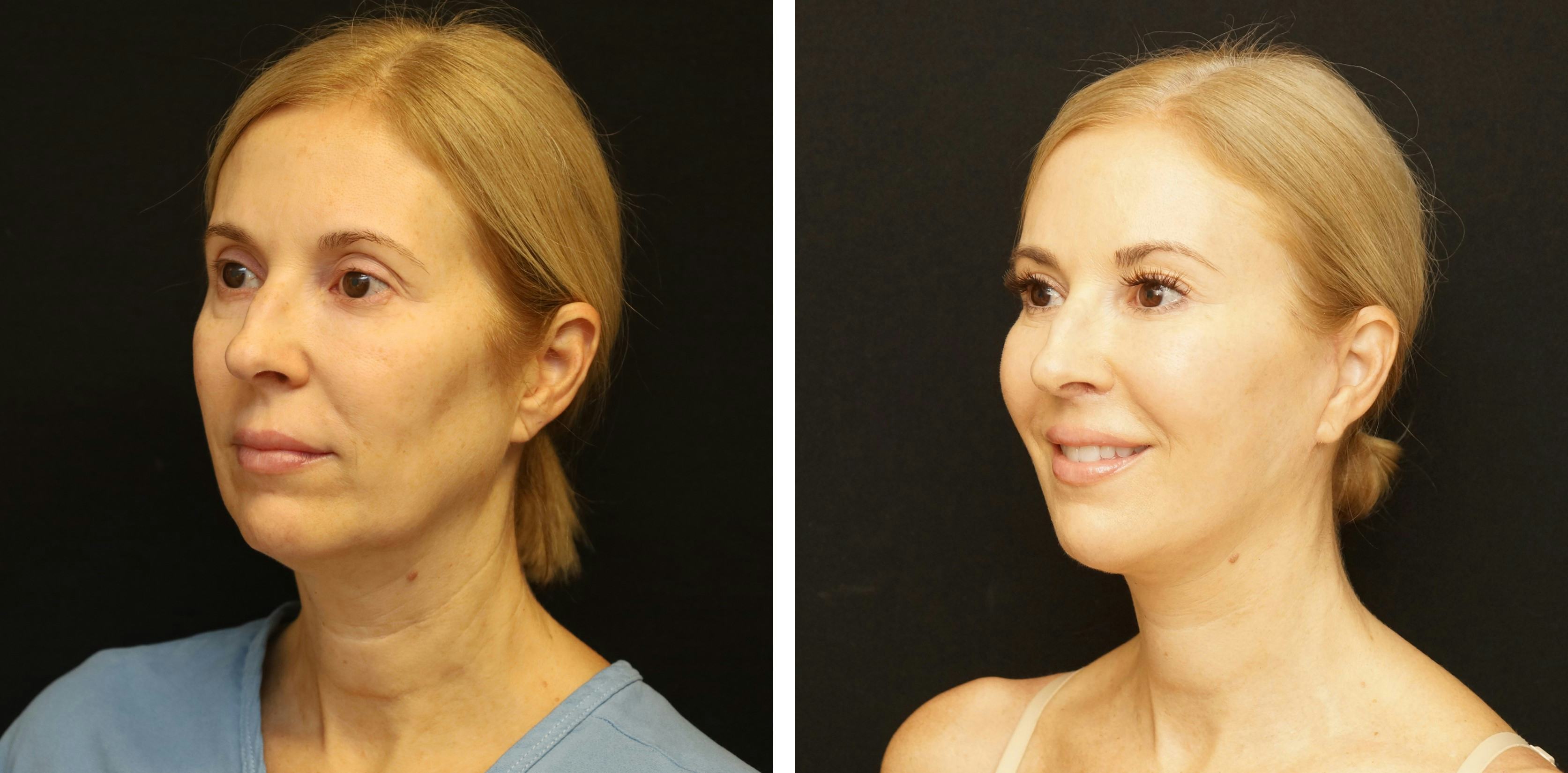 I Got A Facelift & My Before-And-After Photos Are Incredible