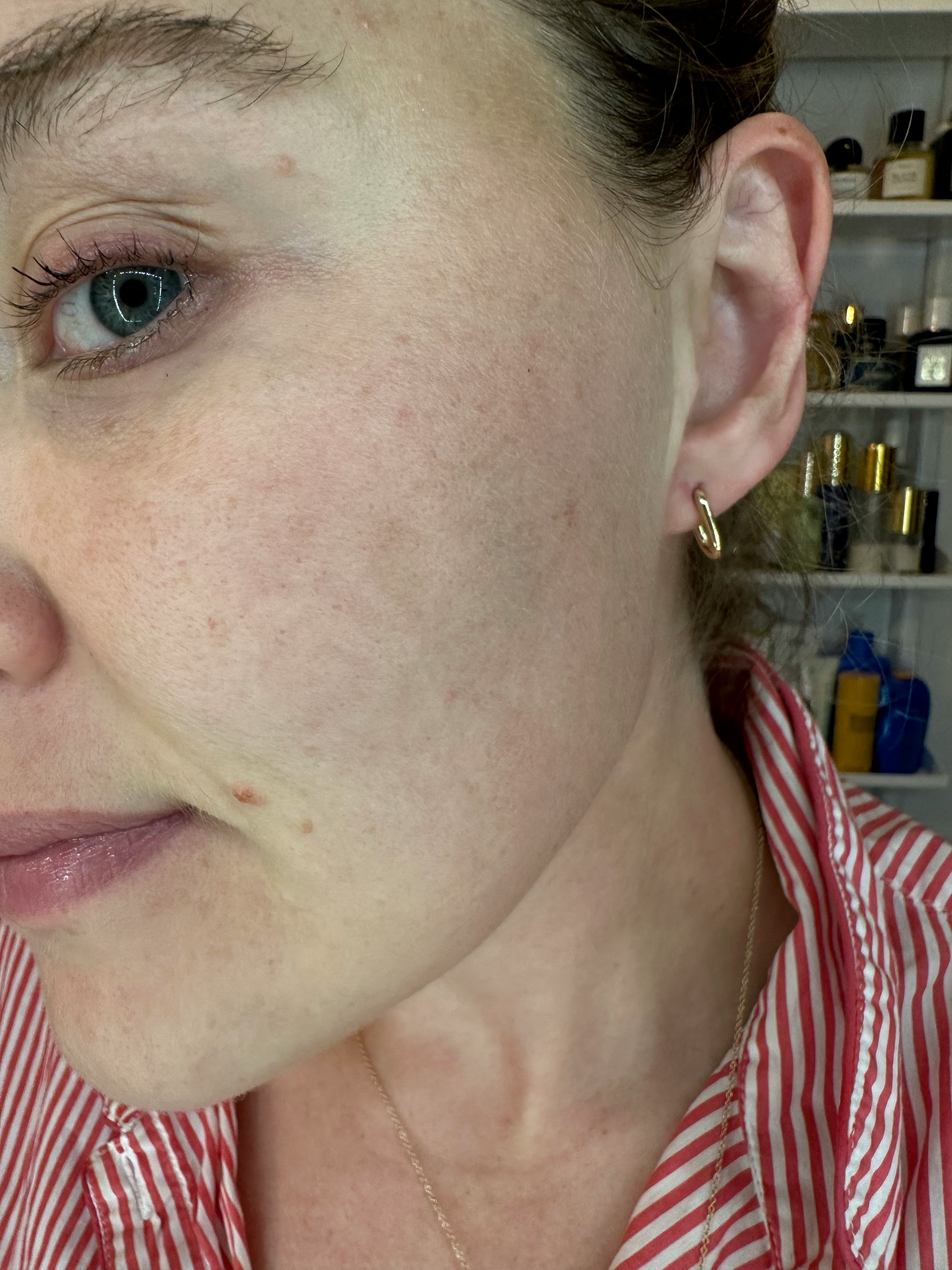 LYMA Laser Review: How The $2,700 At-Home Skin Treatment Transformed My ...