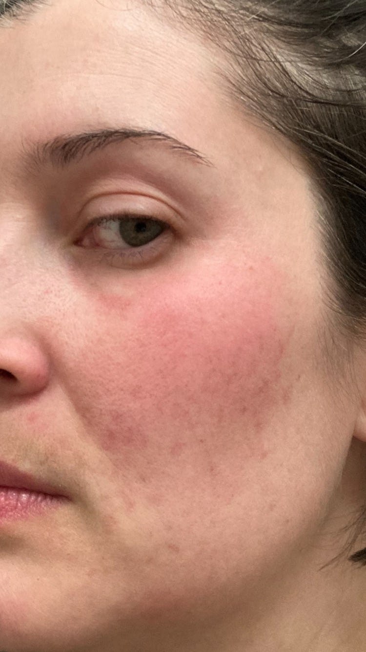 LYMA Laser Review: How The $2,700 At-Home Skin Treatment Transformed My ...