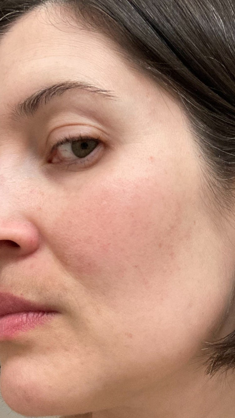 LYMA Laser Review: How The $2,700 At-Home Skin Treatment Transformed My ...