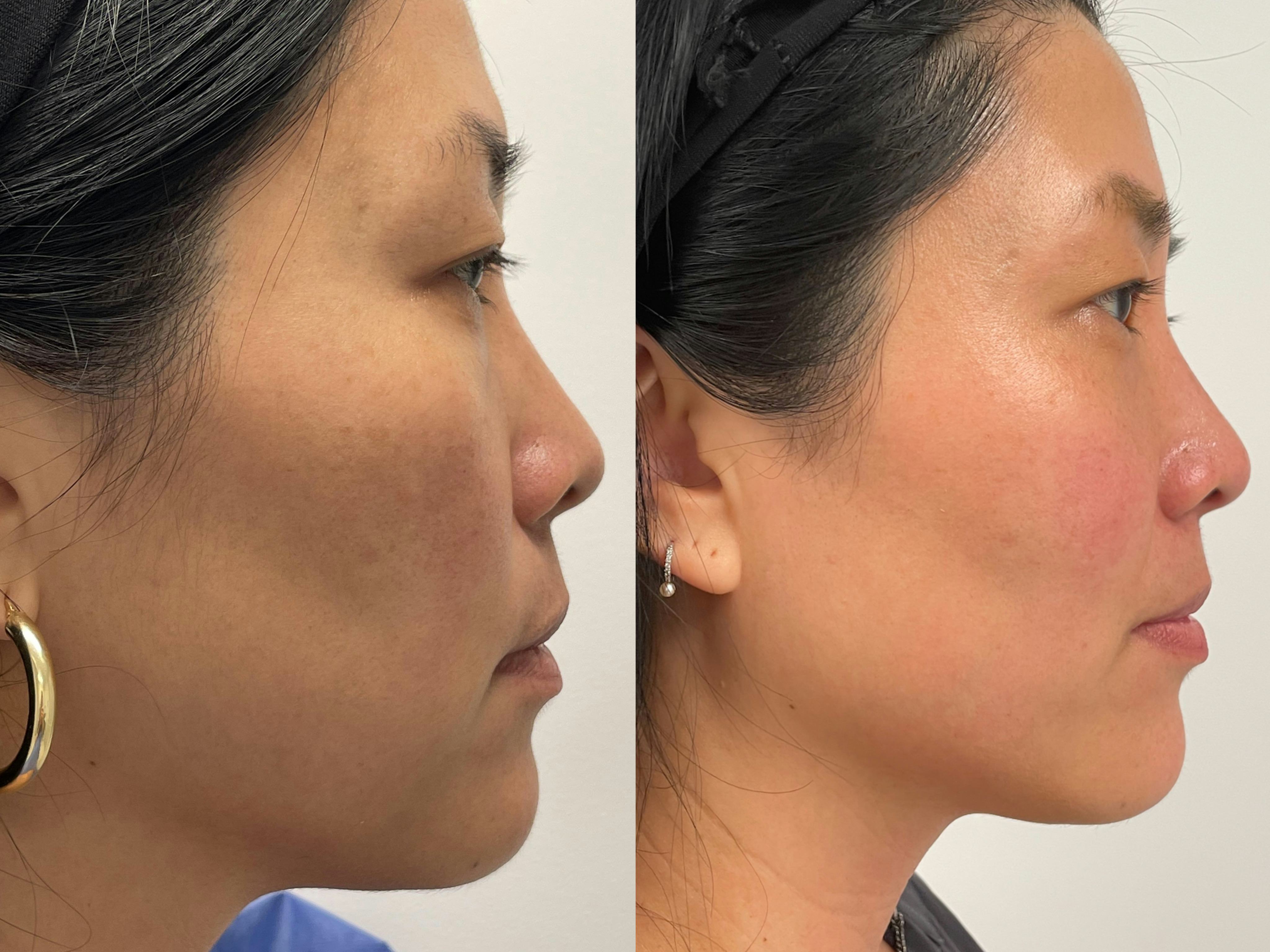 I Tried Morpheus8 For Skin Tightening & I'm Surprised By The Results