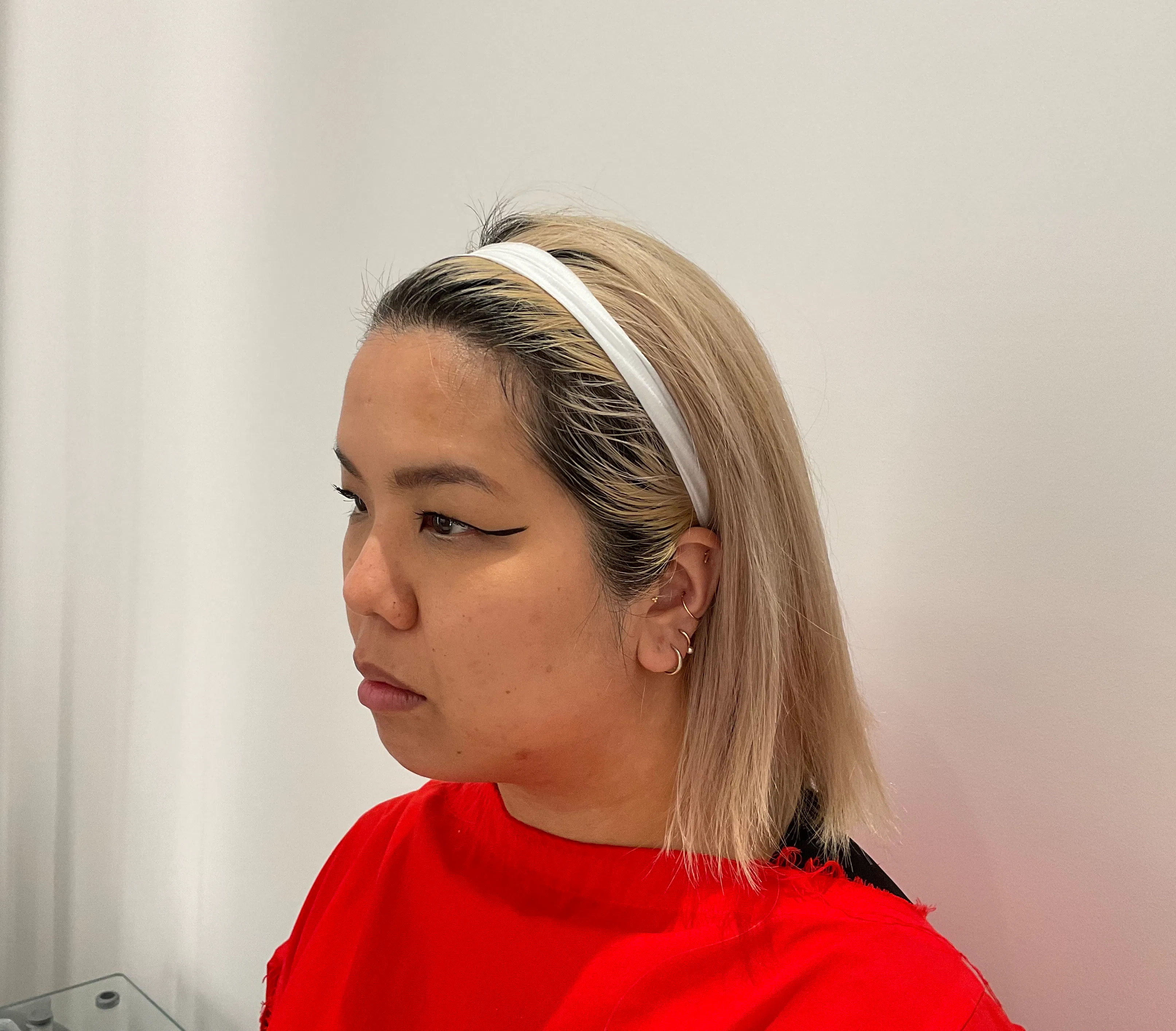 The Laser Treatments That Cleared My Hyperpigmentation