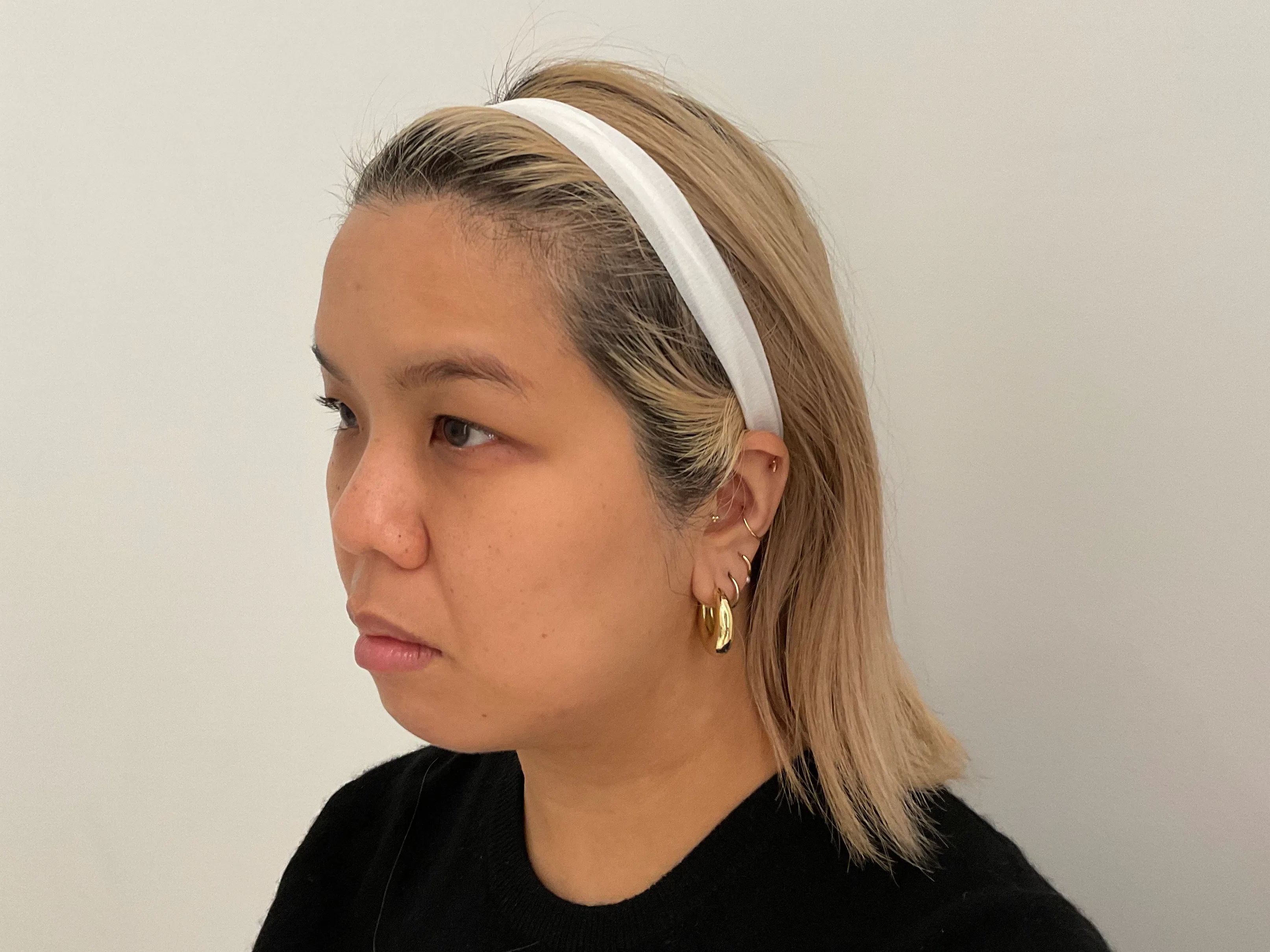 The Laser Treatments That Cleared My Hyperpigmentation