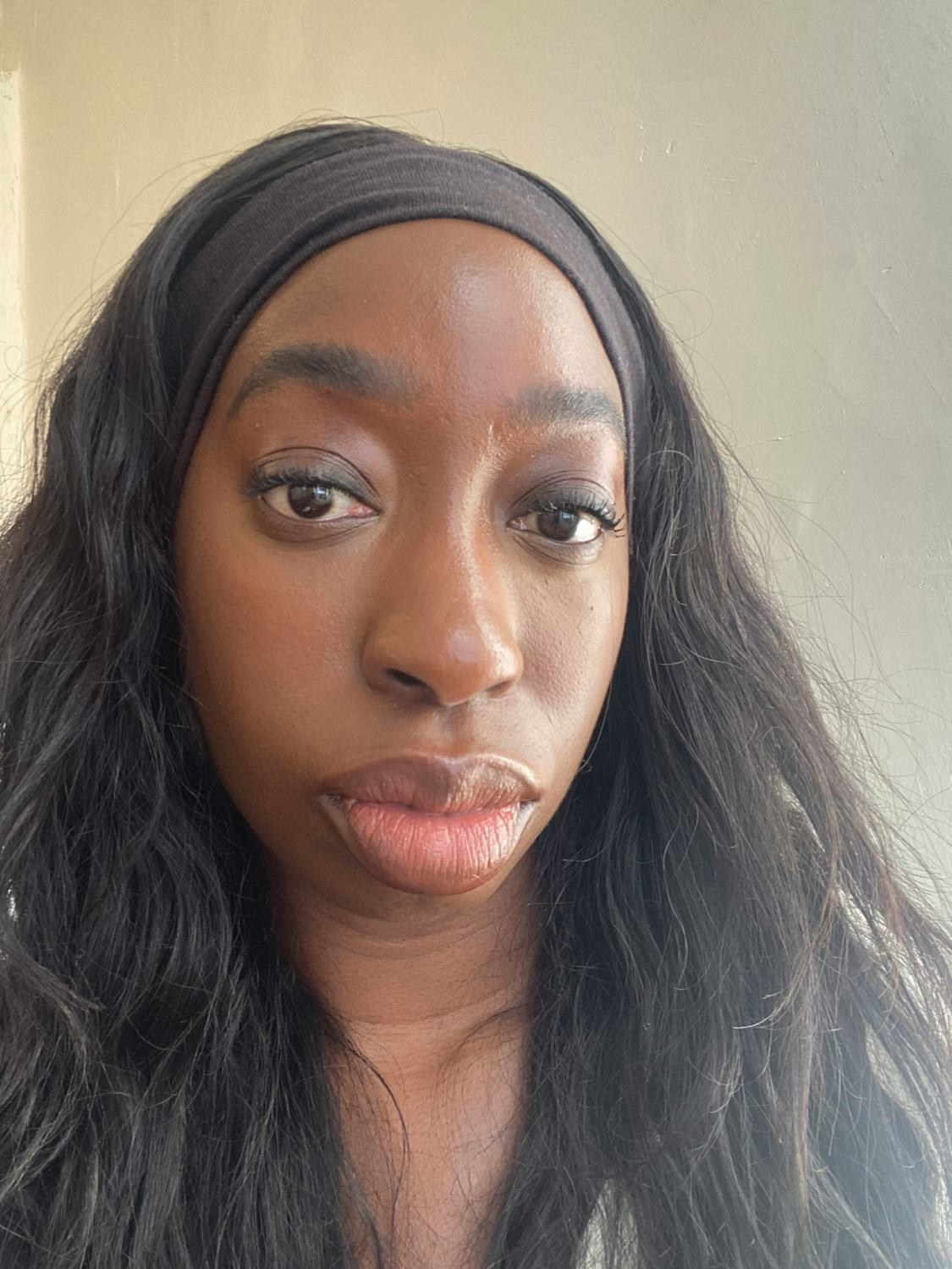 Can Restylane Filler Get Rid Of Under-Eye Bags? An Honest Review