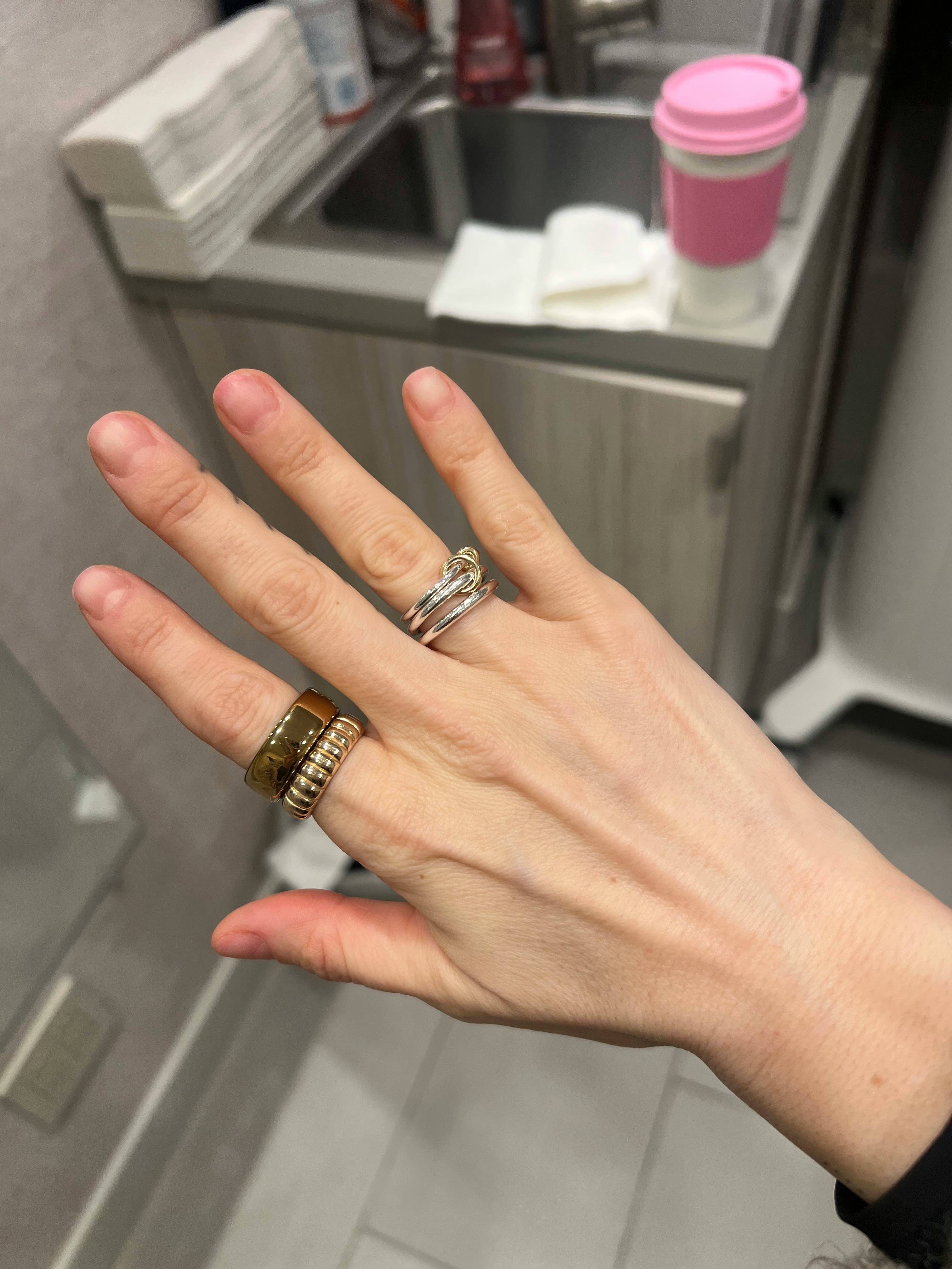 Radiesse Hand Filler Made My Skin So Much Firmer & Smoother