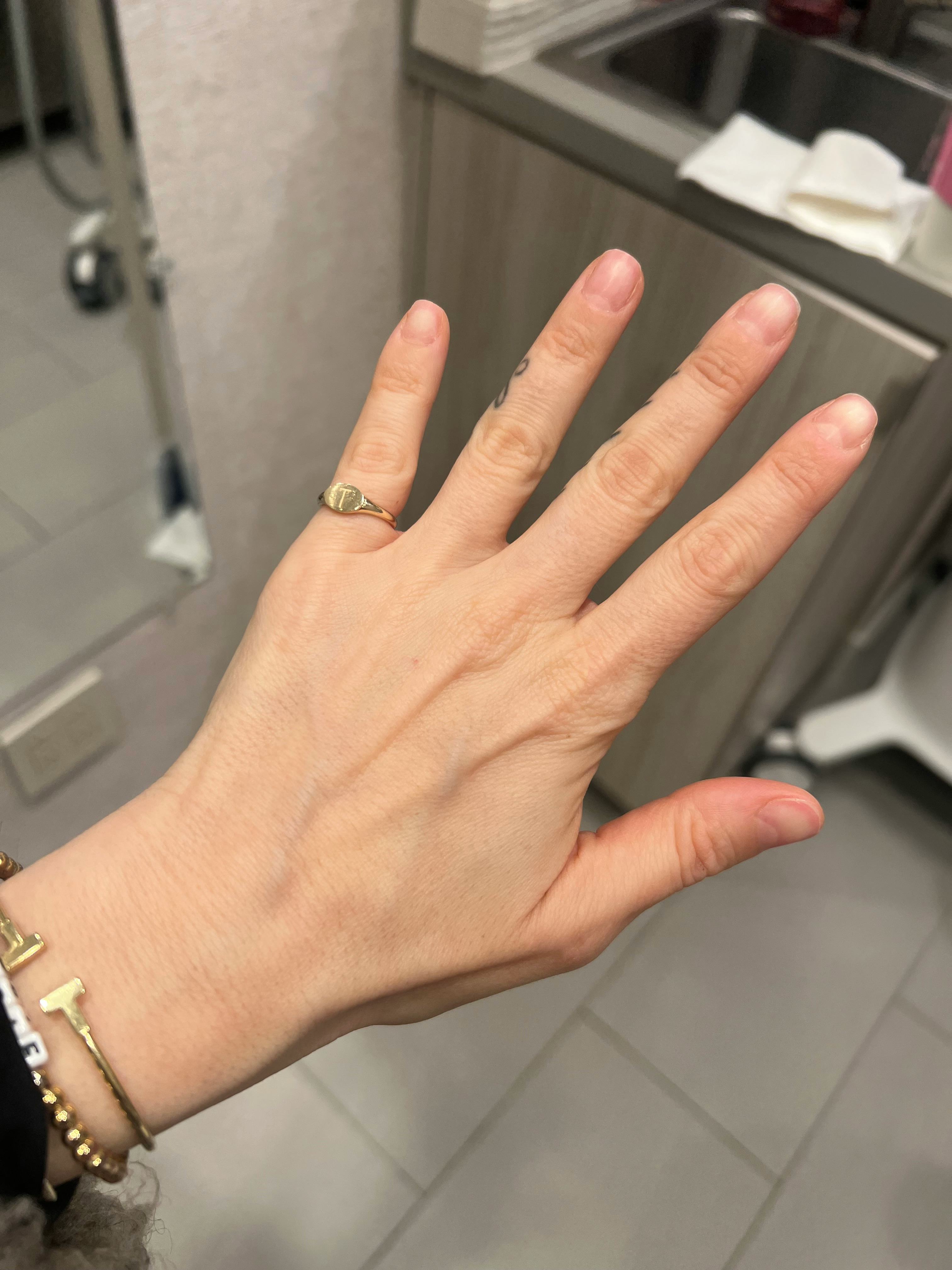 Radiesse Hand Filler Made My Skin So Much Firmer & Smoother
