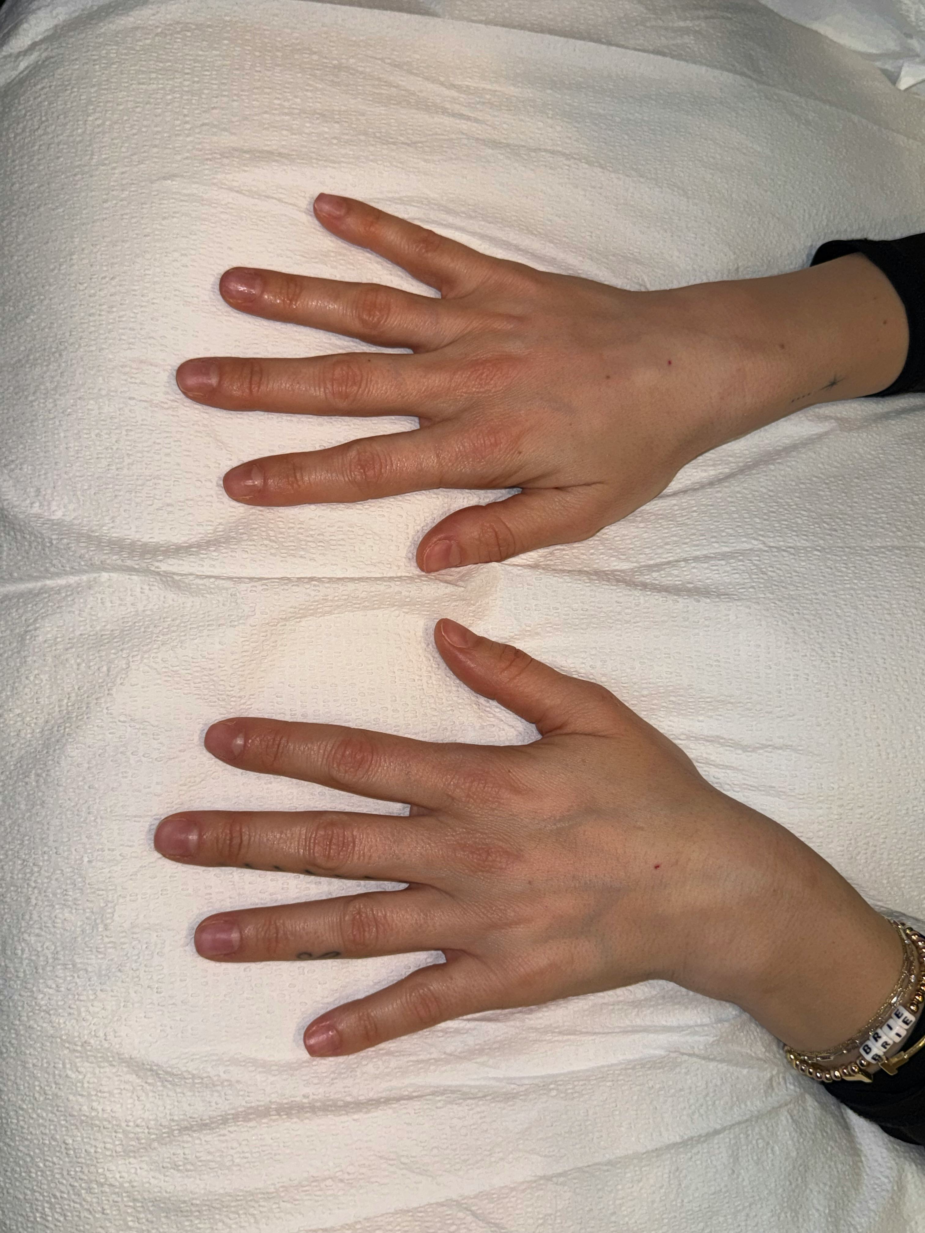 Radiesse Hand Filler Made My Skin So Much Firmer & Smoother