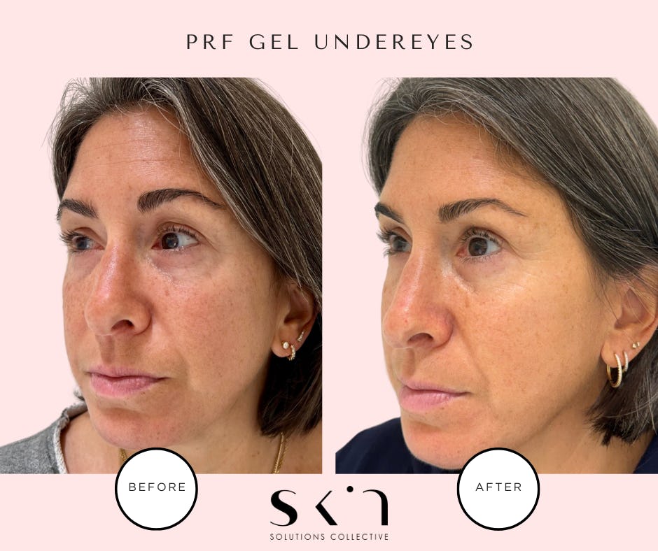 I Got PRF Under-Eye Treatment For Smoother Skin – Here's What It's Like