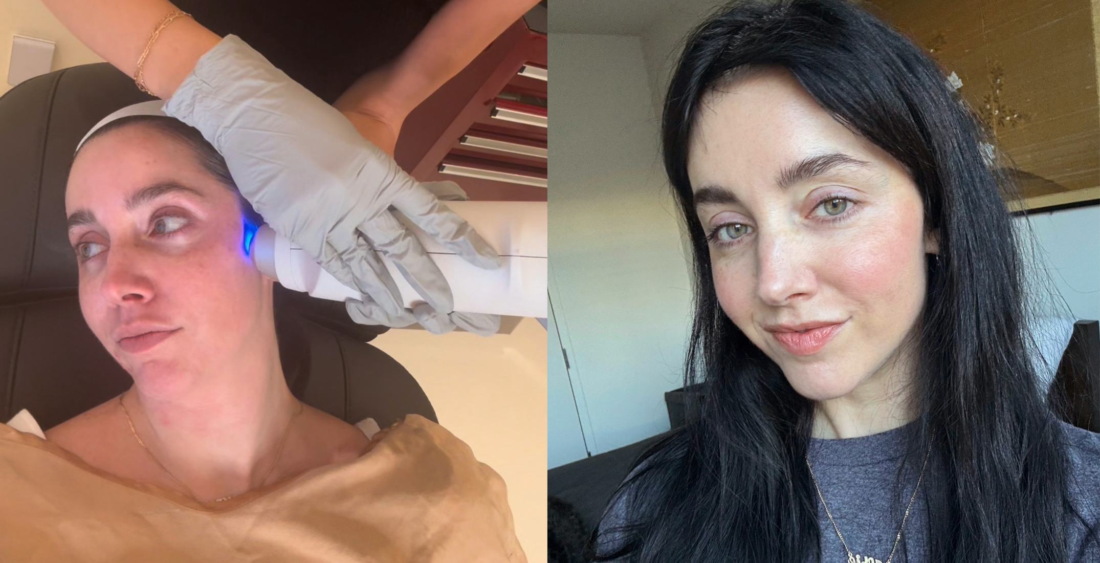 Miria Laser Review: Benefits & Results Of The New Treatment