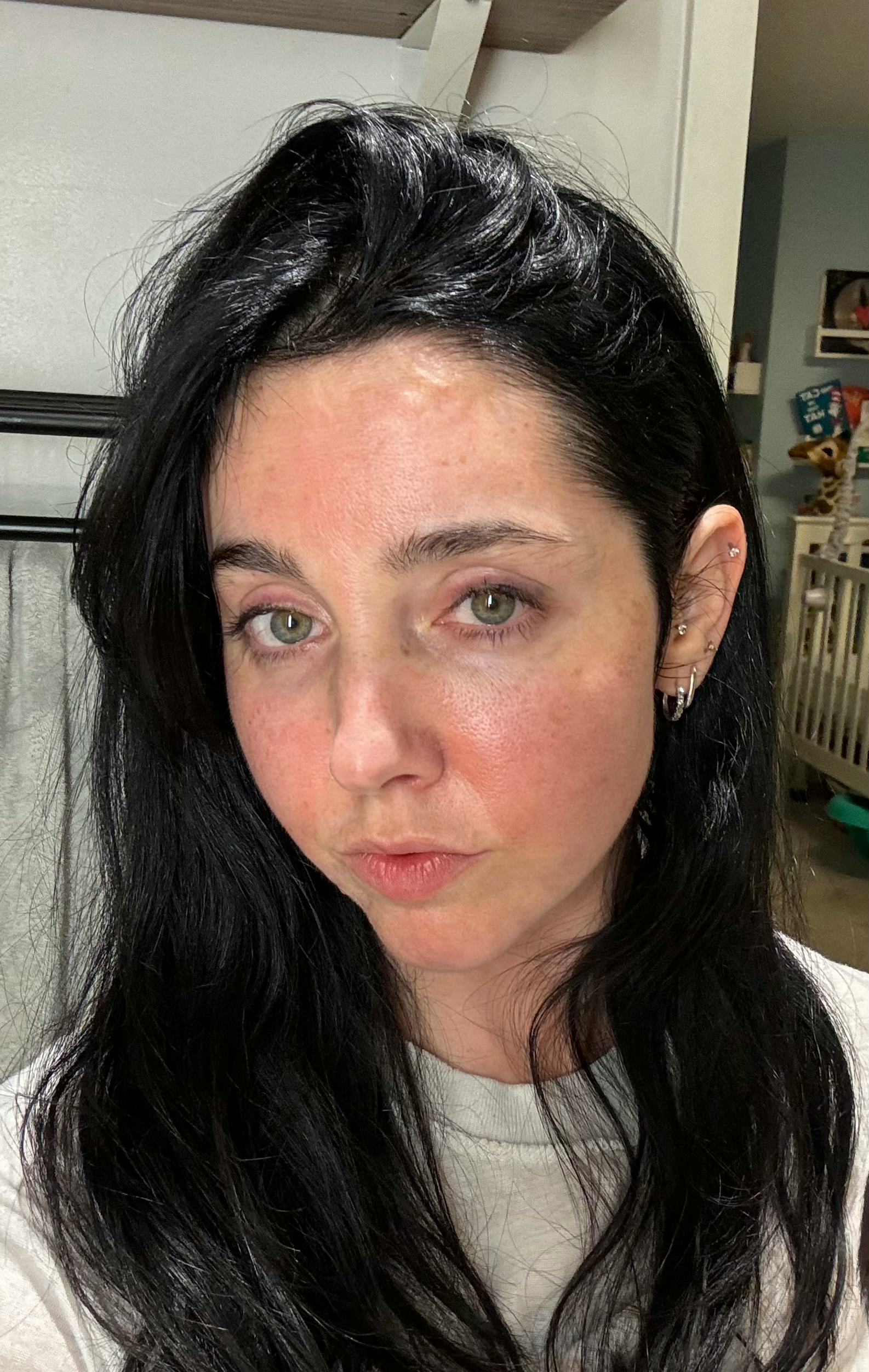 Miria Laser Review: Benefits & Results Of The New Treatment