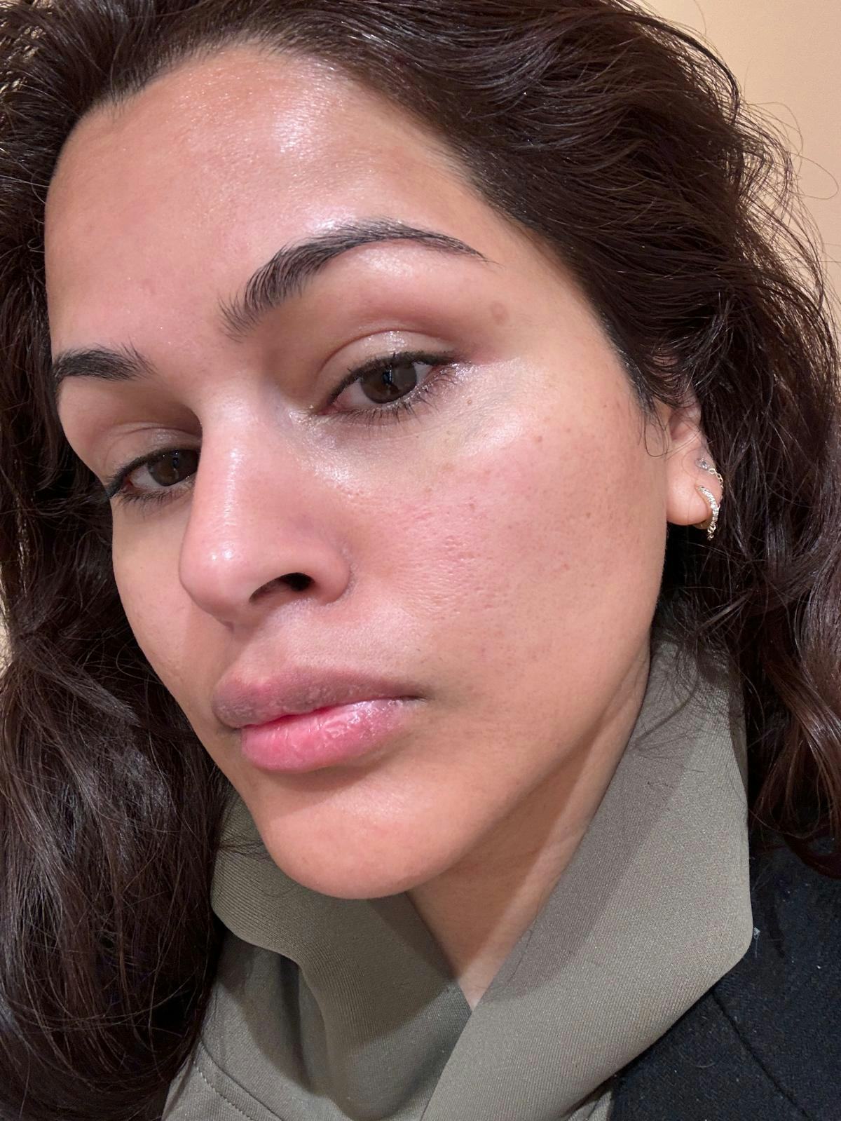 I Got A Botox Facial For Glass Skin – Here's What Happened