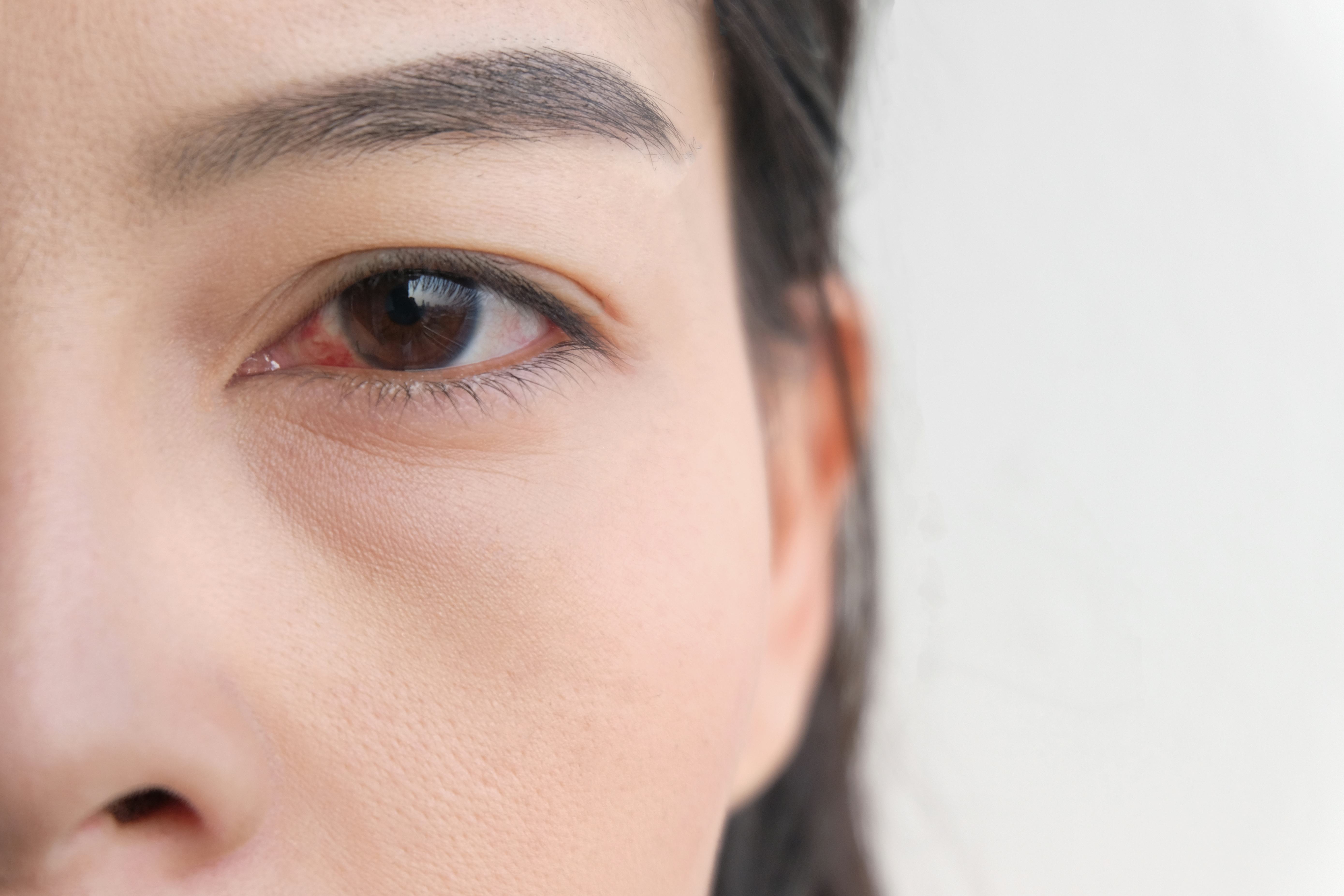 5 Signs Of An Eye Callus You Should Be Aware Of