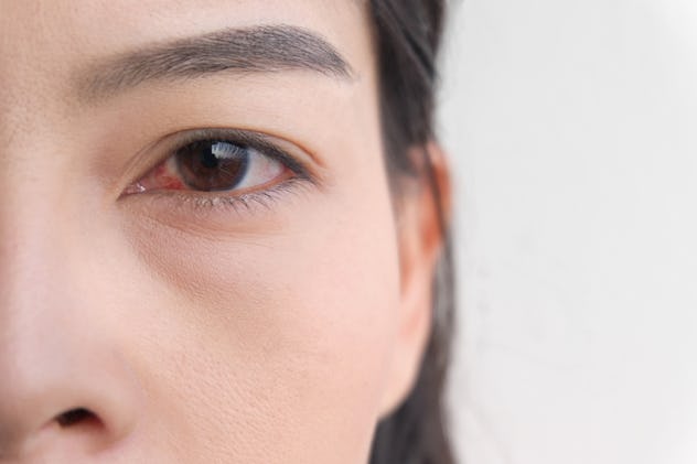 5 Signs Of An Eye Callus You Should Be Aware Of
