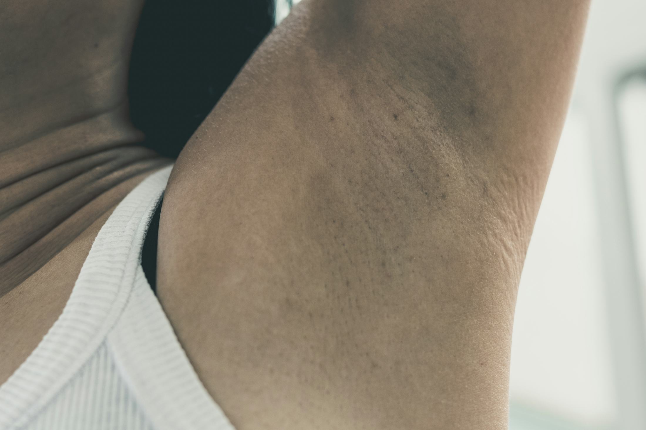 Botox Injections For Your Armpits Can Help Curb Sweating Heres What