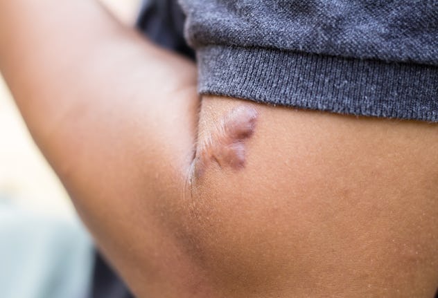 Why Do I Scar So Easily? Here's What It Says About Your Health