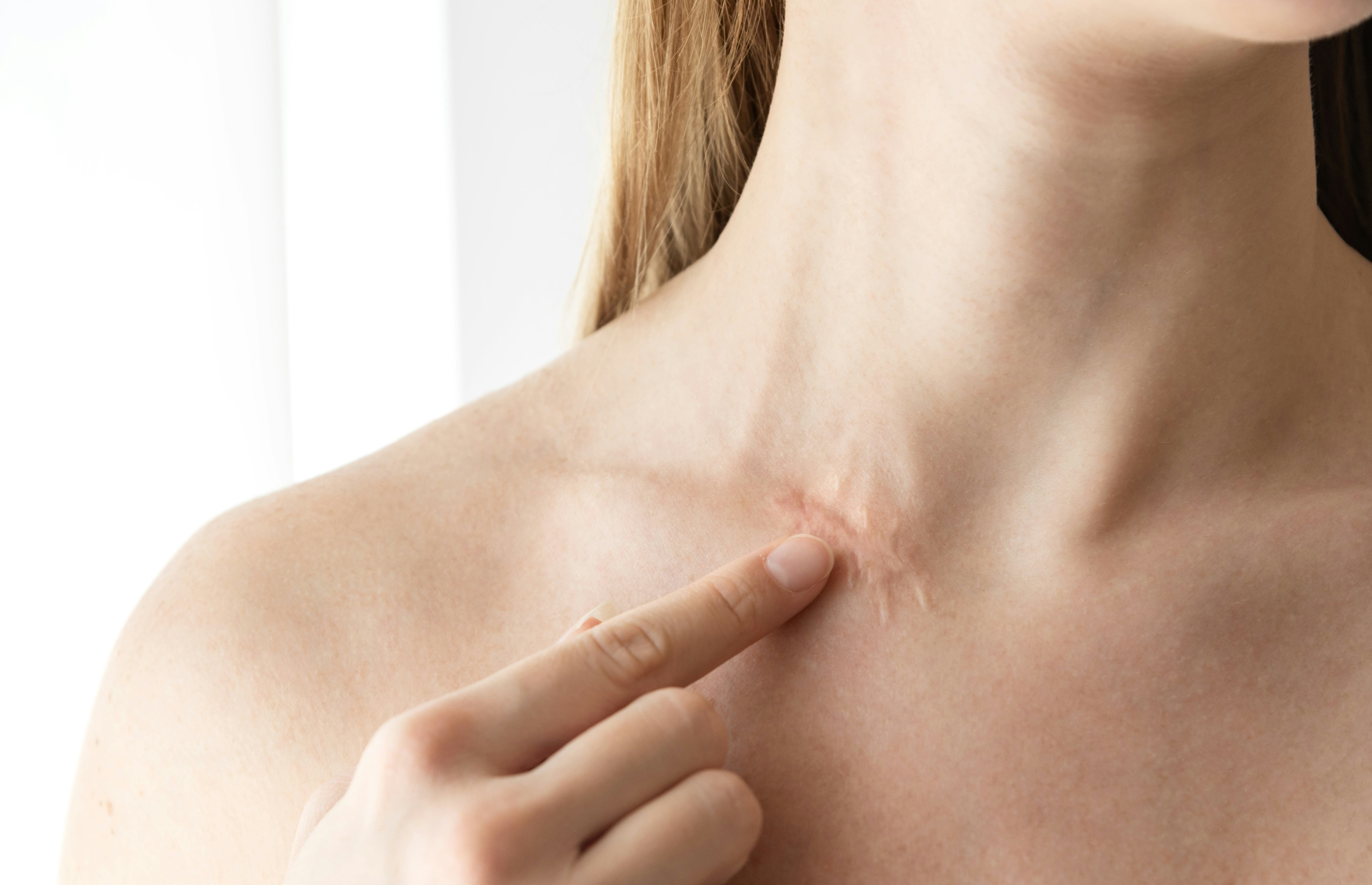 Why Do I Scar So Easily? Here's What It Says About Your Health