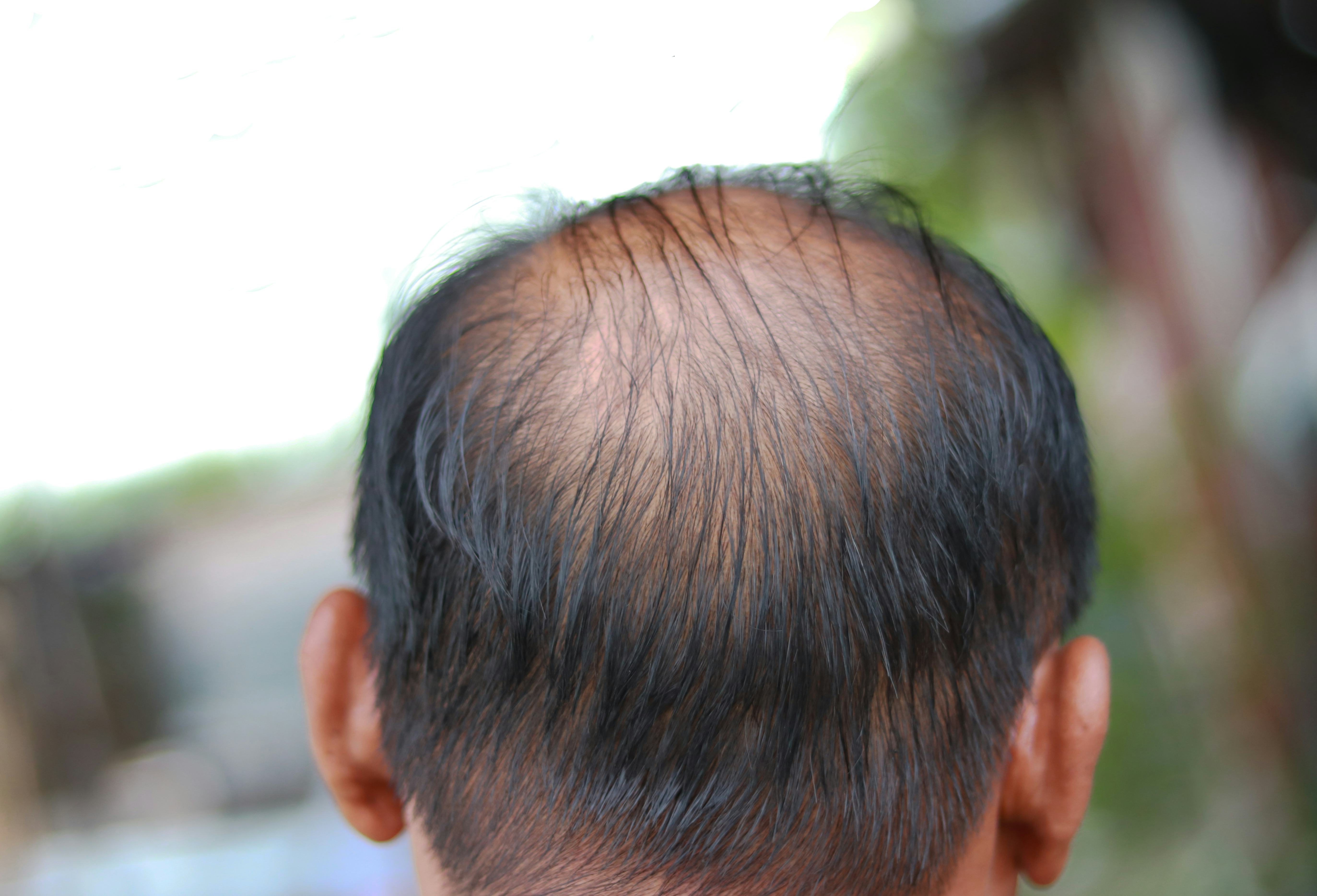 Hair loss: Six scientifically proven strategies to reverse baldness