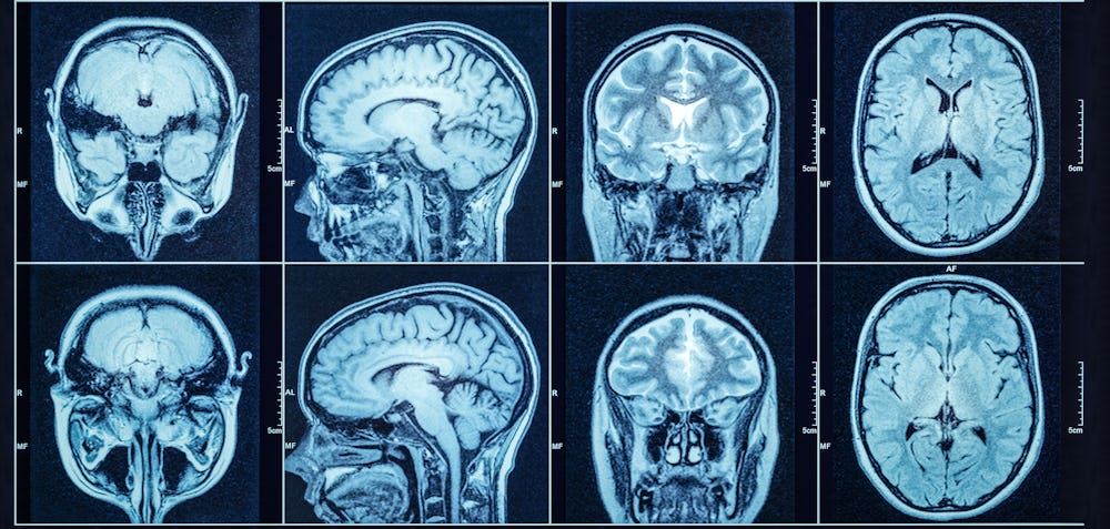 What does ketamine do to your brain? 4 critical facts you need to know